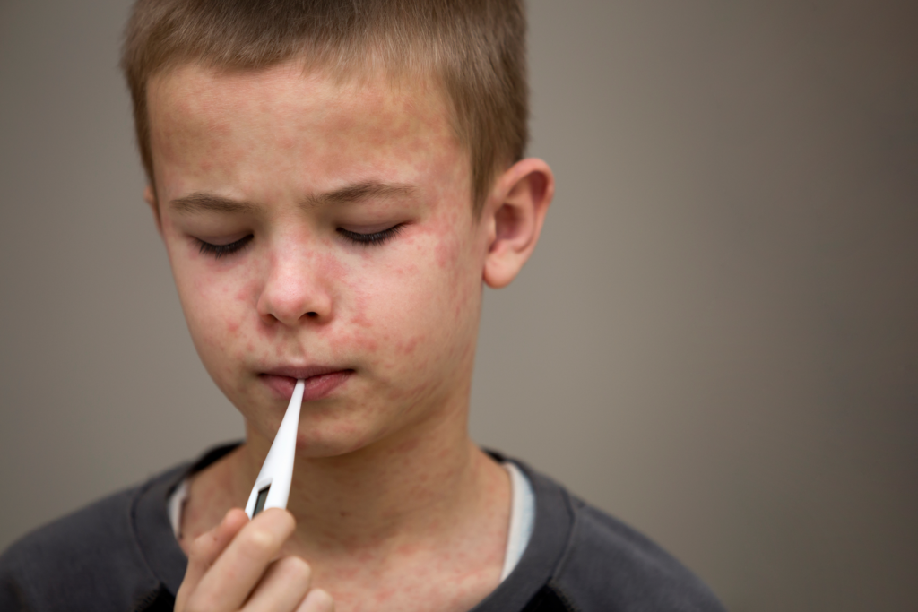 What Signs to Look Out for During Measles Outbreak - Texarkana ...
